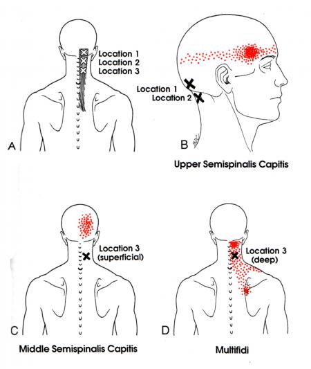 Semispinalis Capitis | The Trigger Point & Referred Pain Guide Semispinalis Capitis | The Trigger Point & Referred Pain Guide